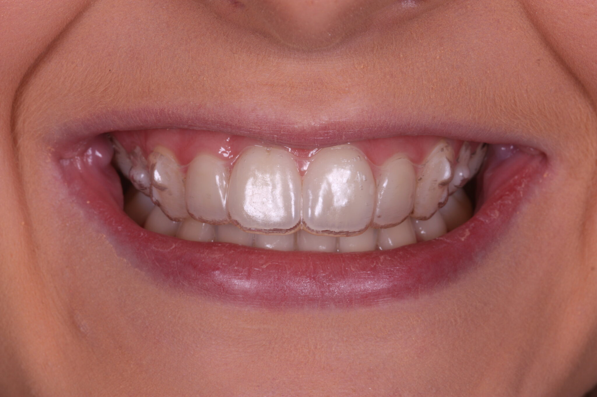 Invisalign- Is it right for me? - Moira Cosmetic Dental